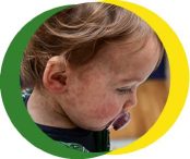 Rashes - NHS Nottingham and Nottinghamshire ICB